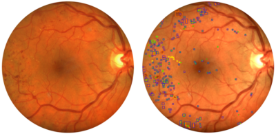Detecting diabetic eye disease early helps prevent vision loss - School ...